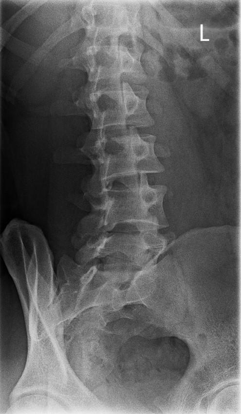 Solved Locate the left L3 pars interarticularis Locate the | Chegg.com