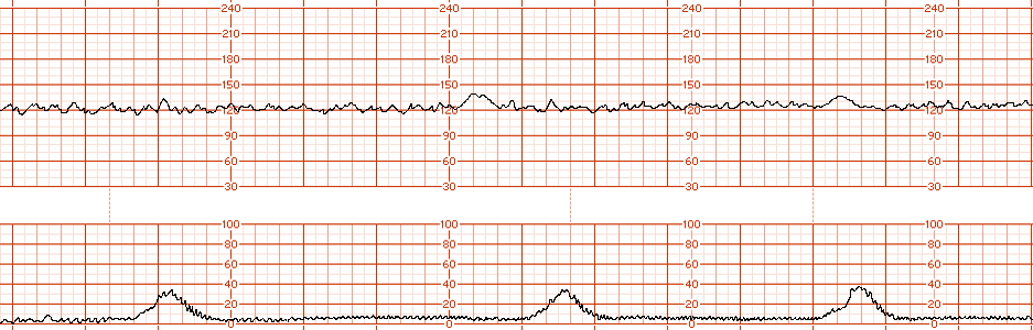 Cassandra is a 24- year-old, G3P1 (G3, T1, P0, A0, | Chegg.com