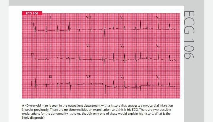 Solved ECG 106 VR V V mi ECG 106 VE V. VE V V A 40-year-old | Chegg.com