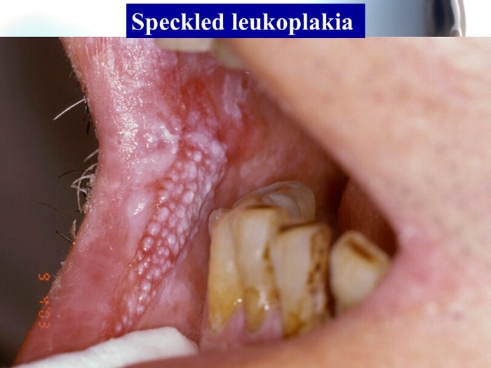Speckled Leukoplakia
