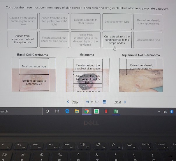 Solved Consider the three most common types of skin cancer. | Chegg.com