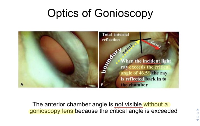 Gonioscopy Angle Recession