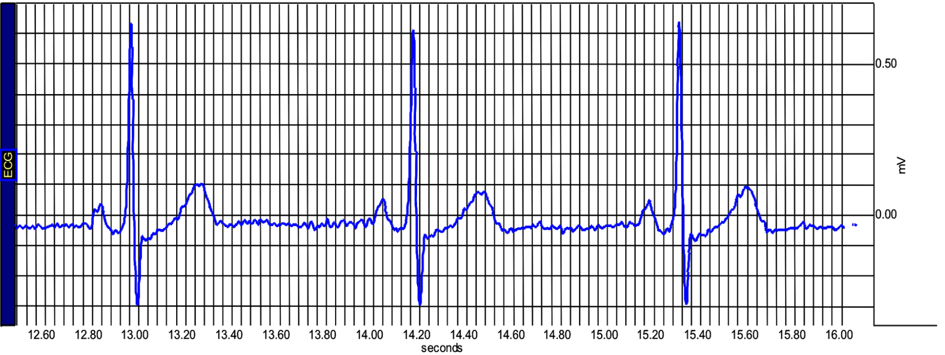 Solved Calculate the duration of the T wave of the second | Chegg.com