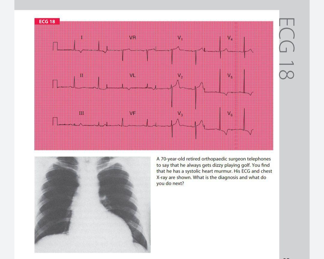 Solved ECG 18 VR V. V. ECG 18 VL VA VE VE V va NU A | Chegg.com