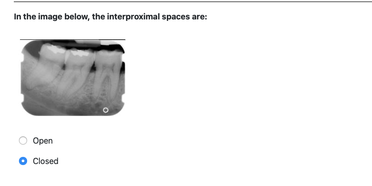 Solved In the image below, the interproximal spaces are: o | Chegg.com