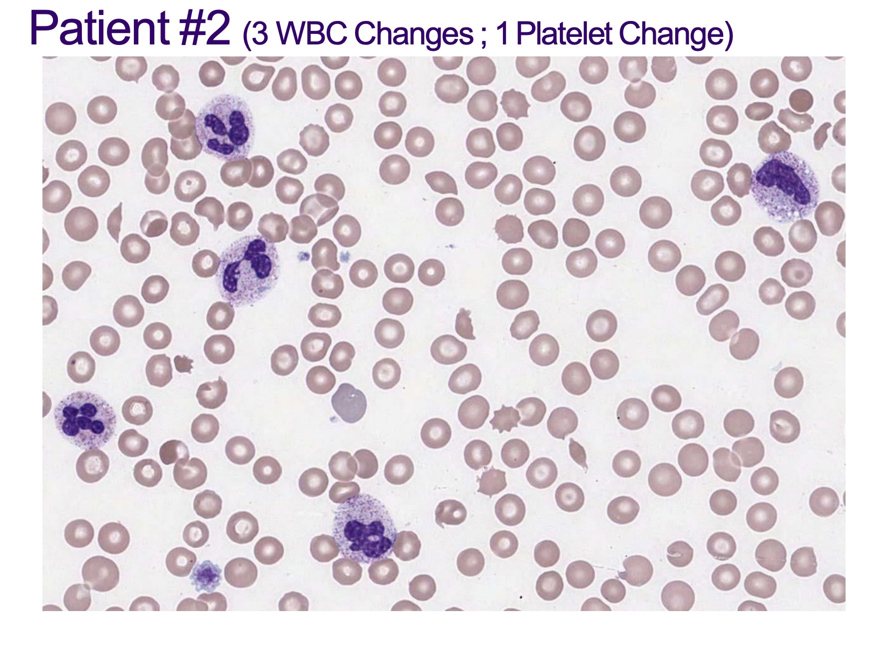 Solved Patient \#1 (1-2 WBC changes; 1-2 Plt changes) Age: | Chegg.com