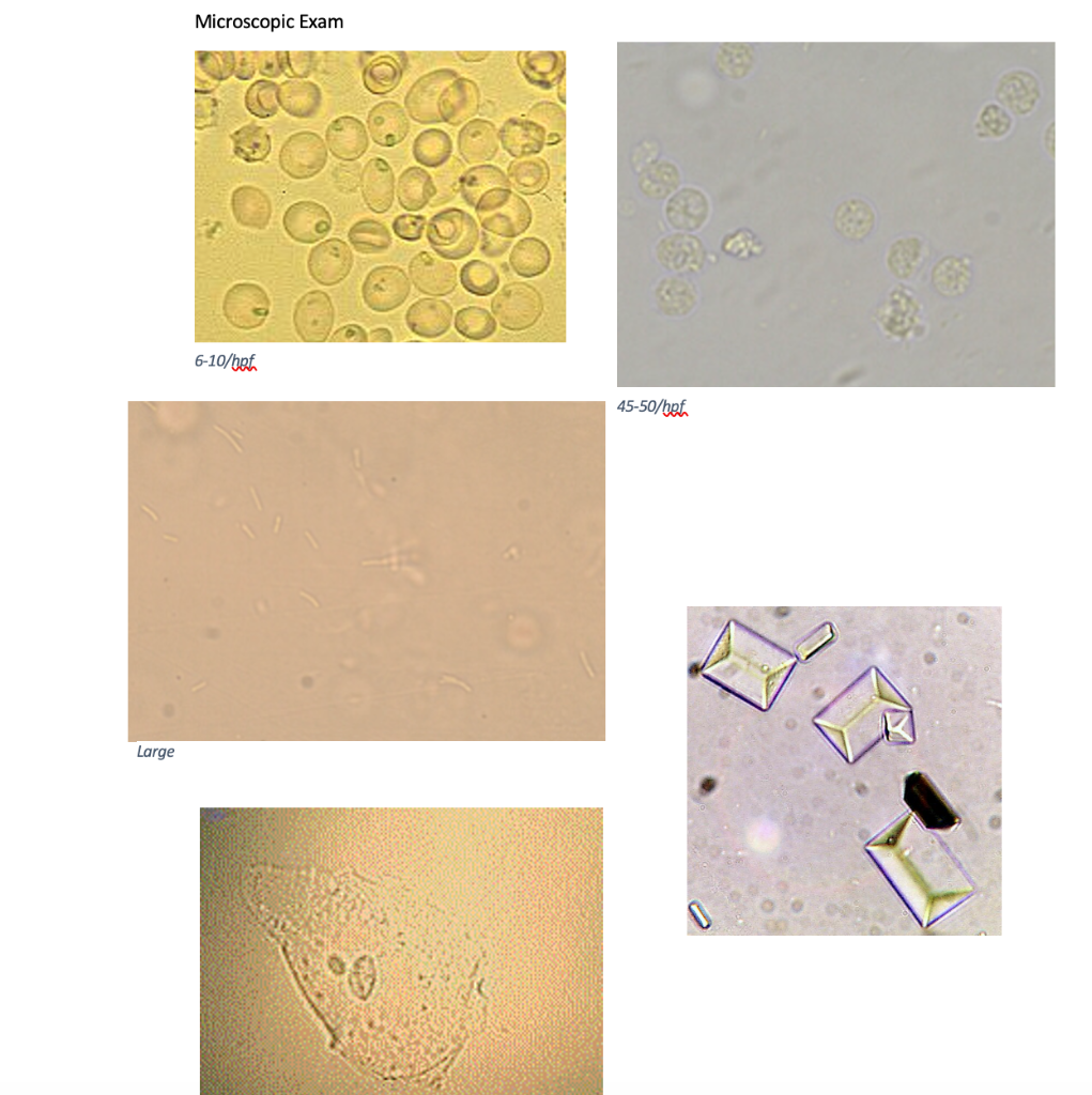 solved-urinalysis-case-study-7-a-30-year-old-female-arrives-chegg