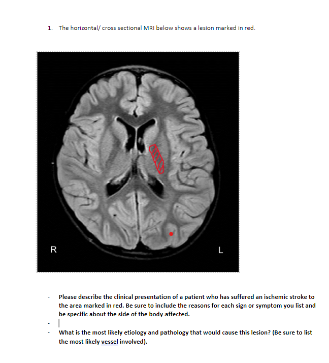 Solved 1. The horizontal/ cross sectional MRI below shows a | Chegg.com