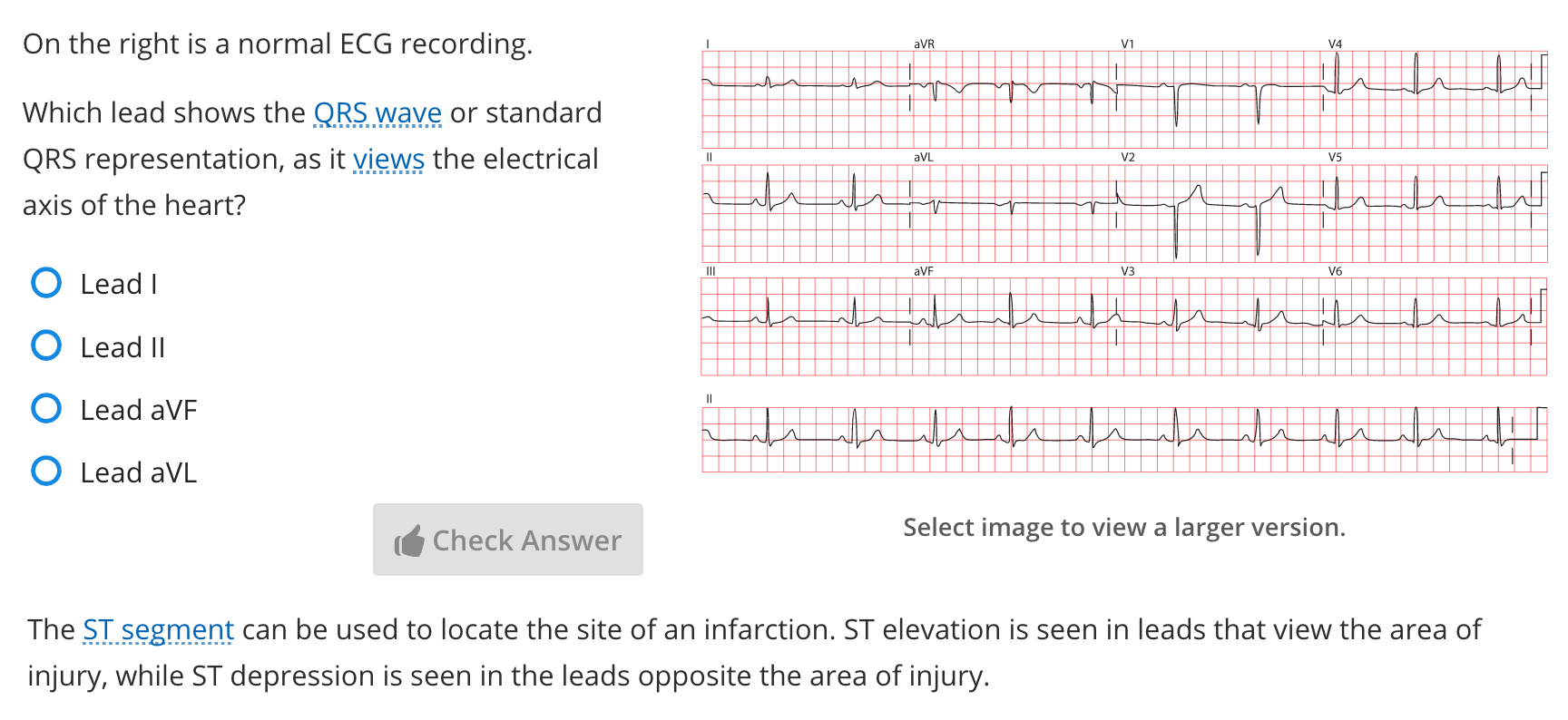 Solved On the right is a normal ECG recording. AVR V1 V4 | Chegg.com