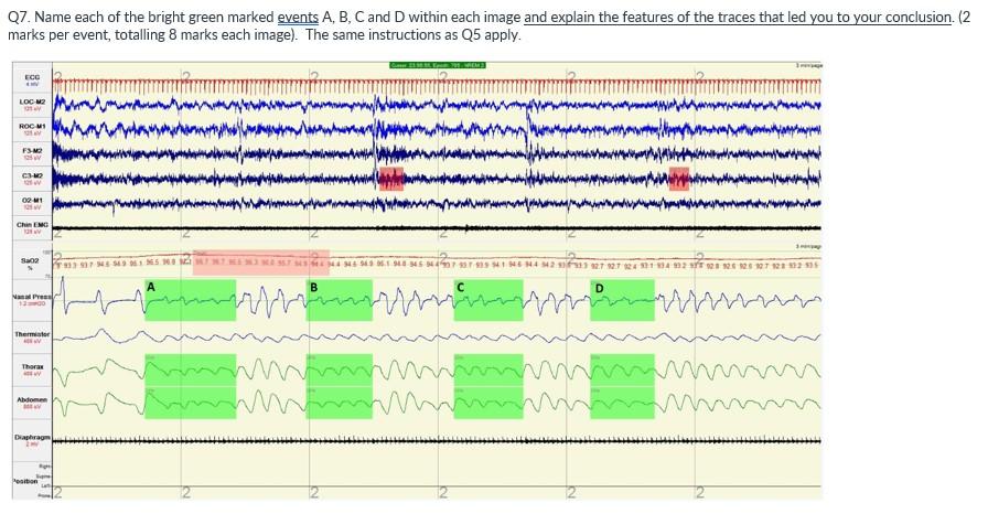 Solved In all images: * EEG arousals are marked by red | Chegg.com