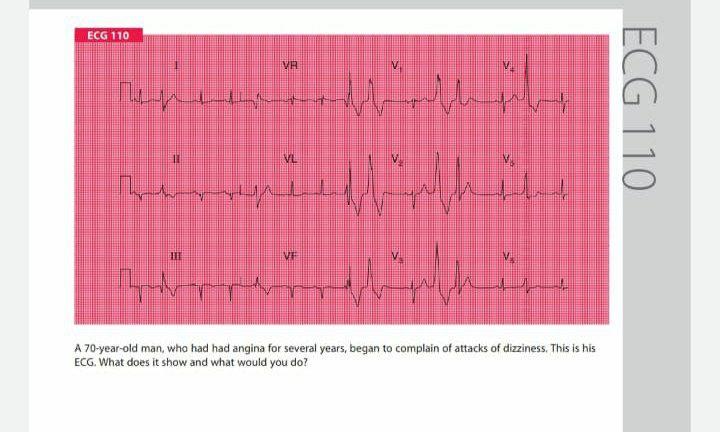 Solved ECG 110 VR V لالا wy ECG 110 11 VL пил 11 VE hand A | Chegg.com