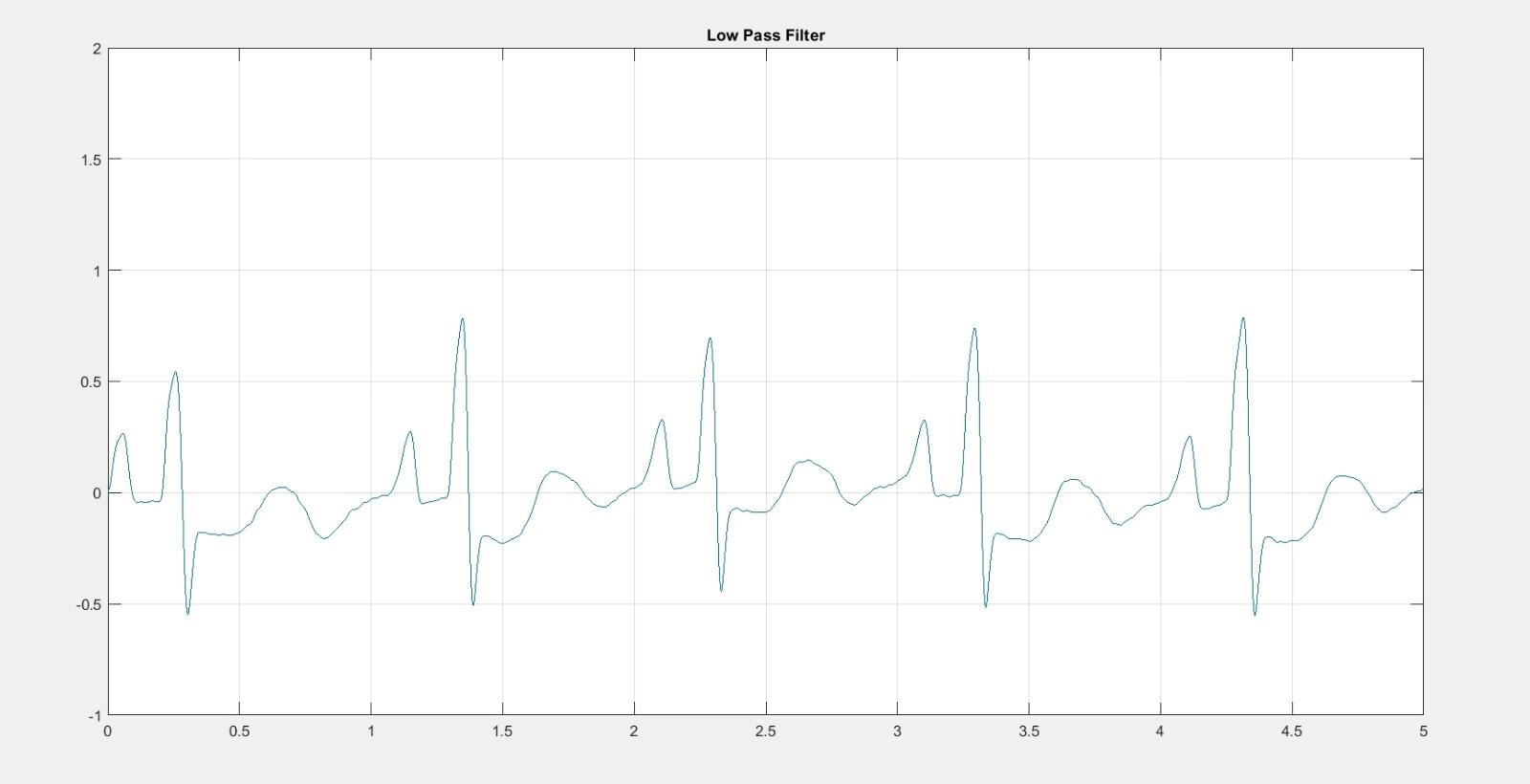 Solved What is the type of arrhythmia in this ECG signal ? | Chegg.com