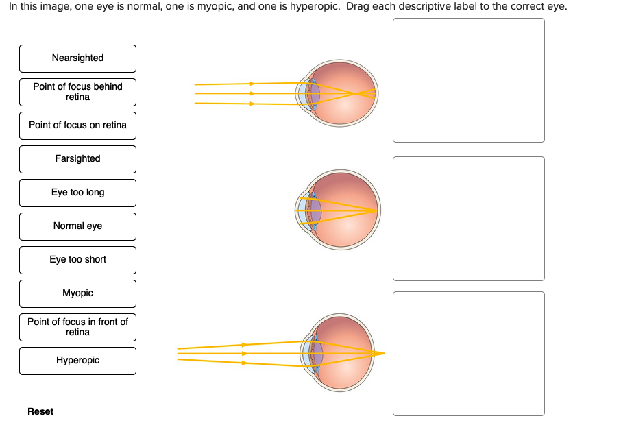 Solved In this image, one eye is normal, one is myopic, and | Chegg.com