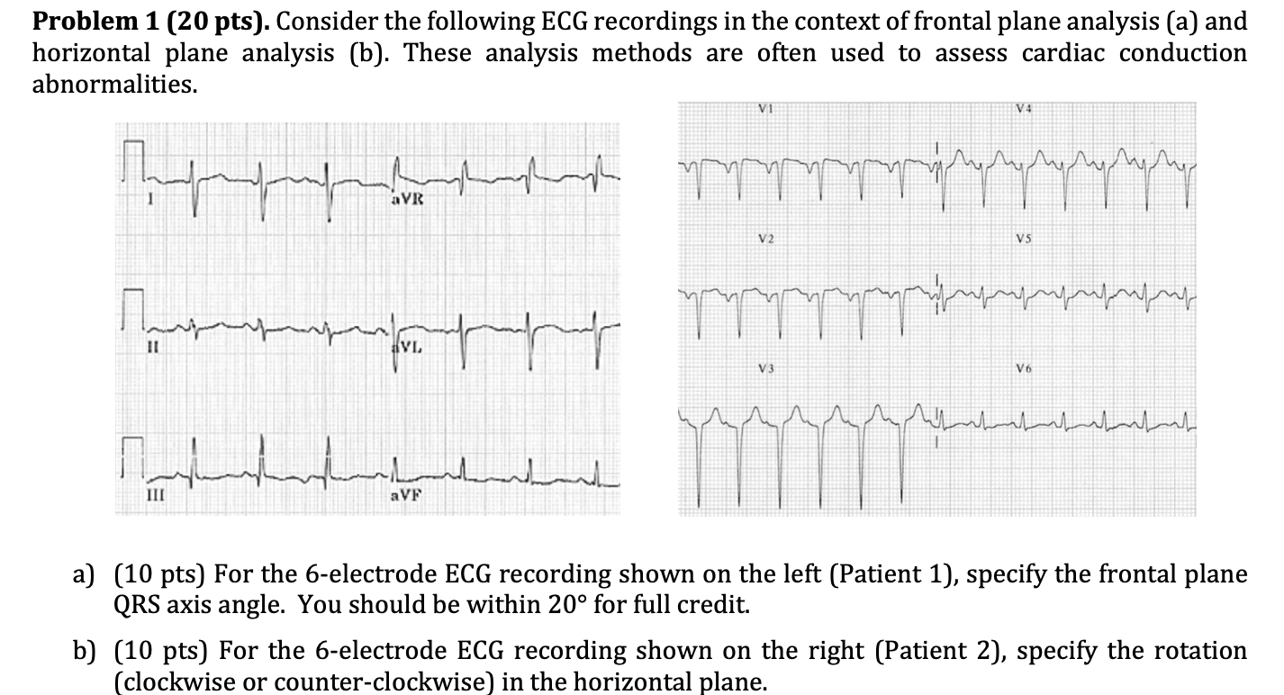 Solved Problem 1 (20 pts). Consider the following ECG | Chegg.com