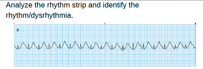 Solved Analyze the rhythm strip and identify | Chegg.com