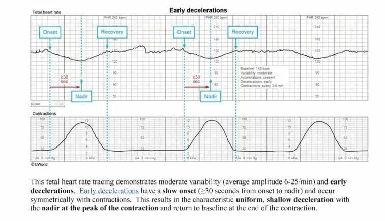 Fetal heart rate Early decelerations THE Onso: | Chegg.com
