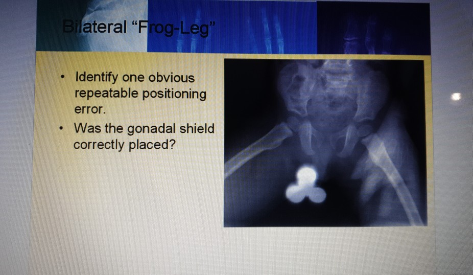 Solved Bilateral "Frog-Leg" • Identify one obvious | Chegg.com