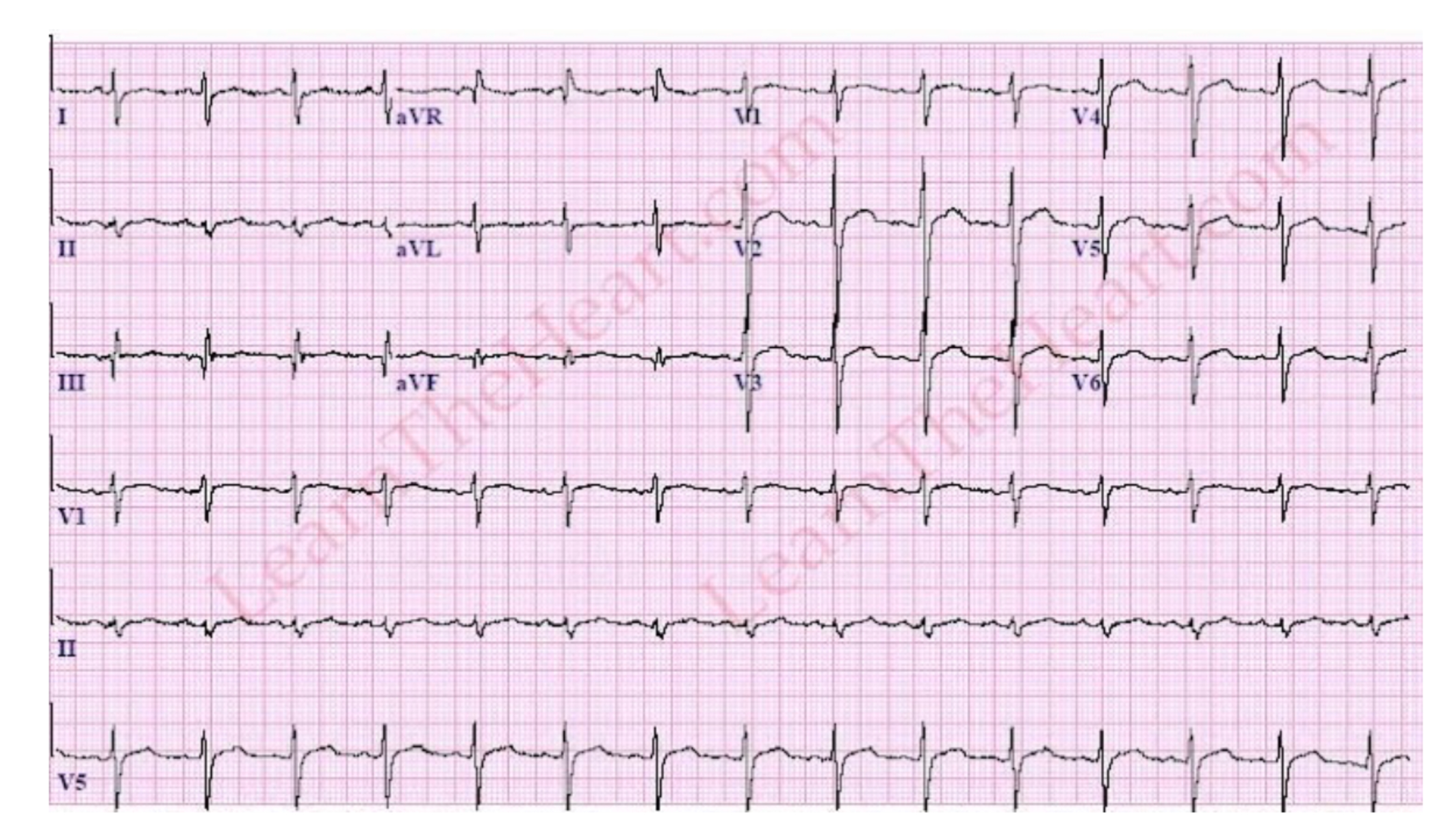 Solved based on the ECG below, what is the axis of ECG | Chegg.com