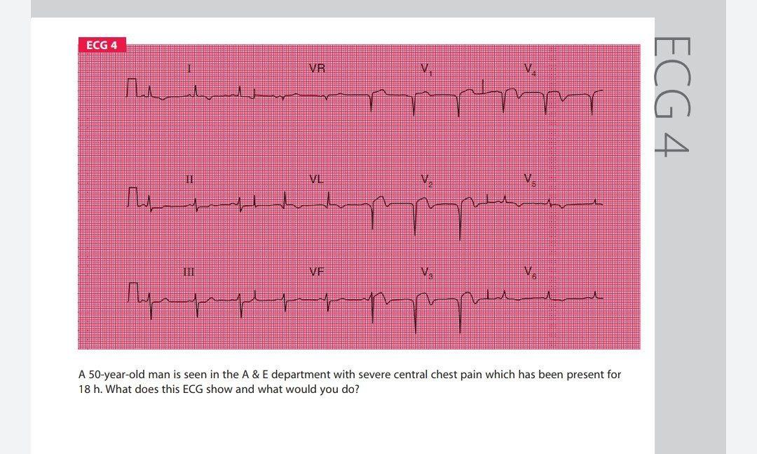 Solved ECG 4 VR V V Samo n ECG 4 DI VL V. VE V V. Myny A | Chegg.com