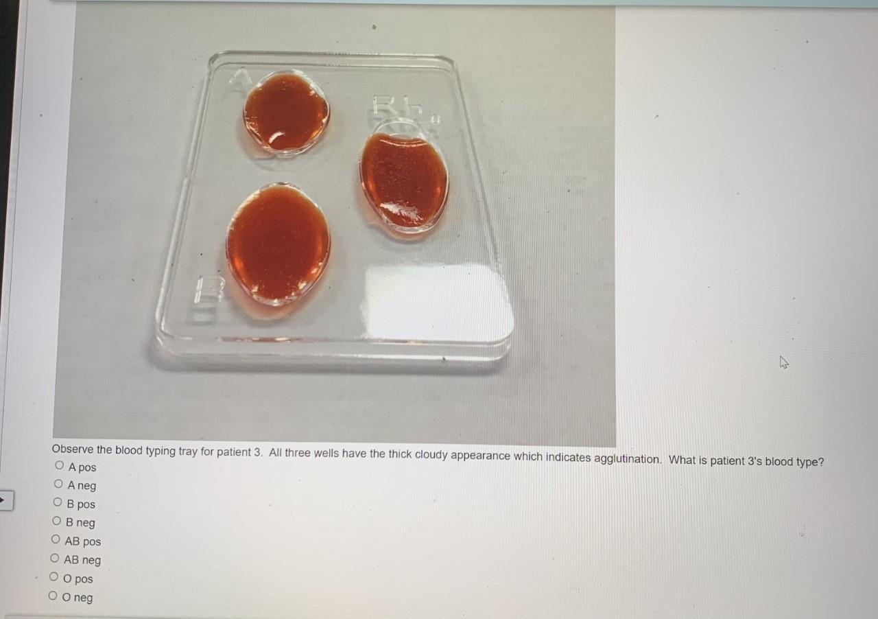 Solved R Observe the blood typing tray for patient 3. All | Chegg.com