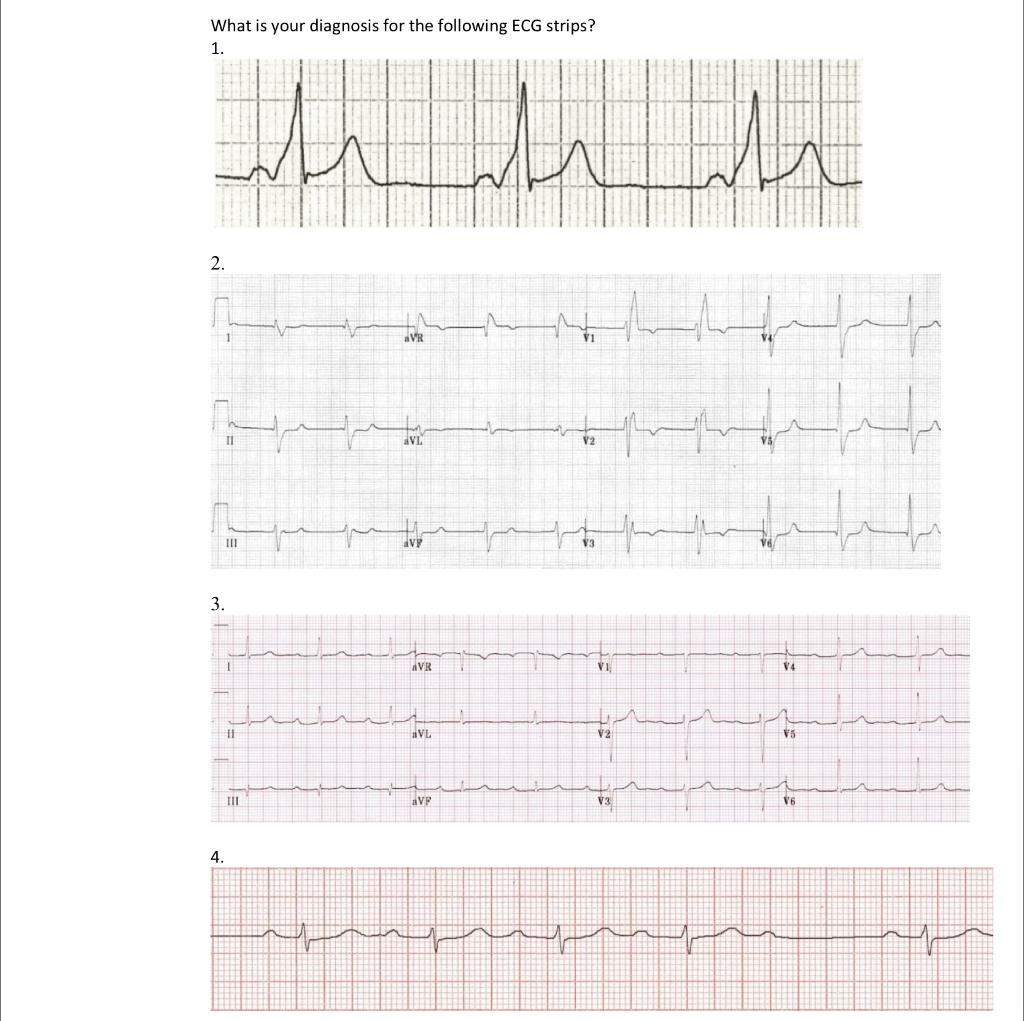 Solved What is your diagnosis for the following ECG strips? | Chegg.com