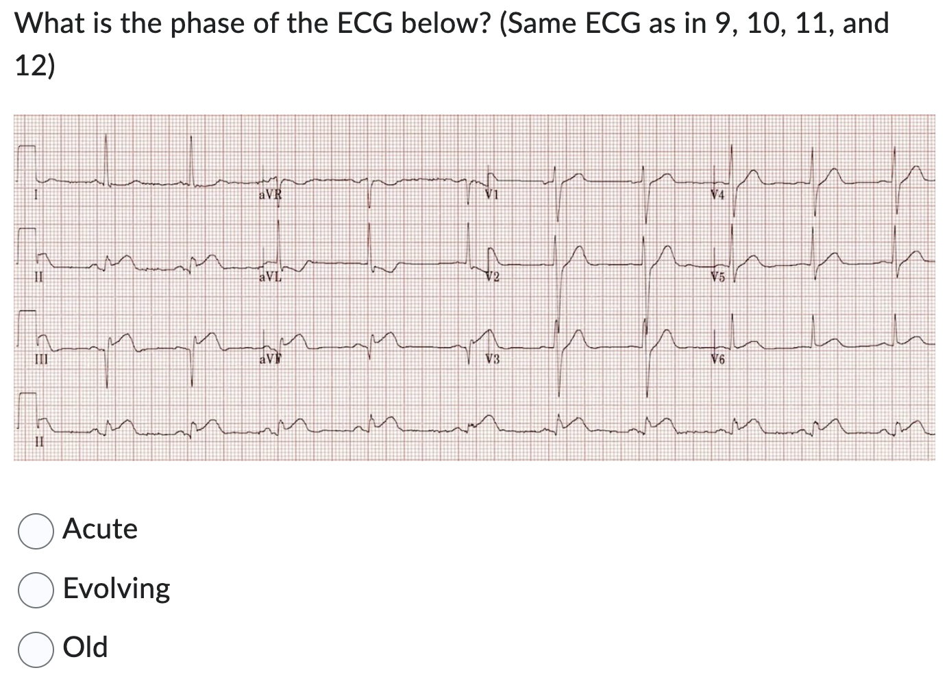 Solved What is the phase of the ECG below? (Same ECG as in | Chegg.com