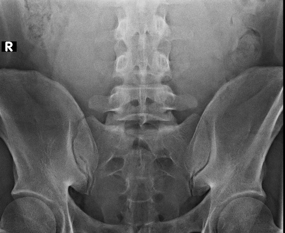 Solved Locate the left L3 pars interarticularis Locate the | Chegg.com