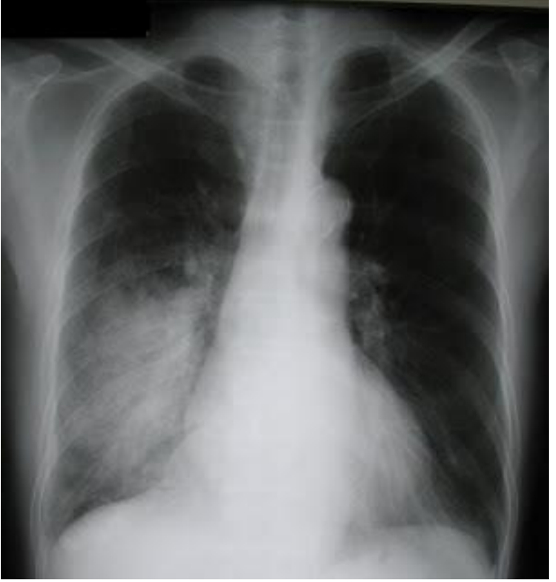 Solved 2- ﻿interpret this CXR and explain reasoning behind | Chegg.com