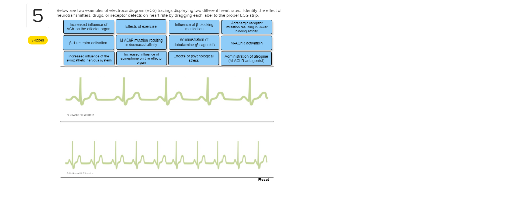 Solved 5 Below are two examples af electrocardiagram (ECG) | Chegg.com
