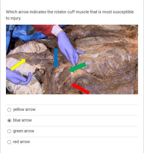 Solved Which arrow indicates the rotator cuff muscle that is | Chegg.com