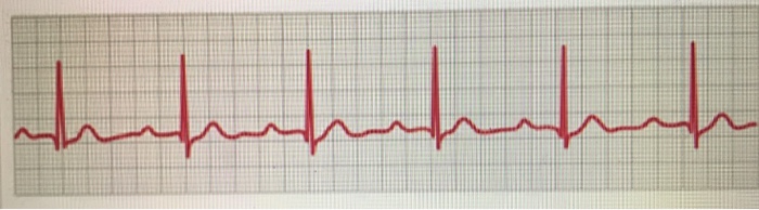Solved For the EKG trace below calculate the P-R interval | Chegg.com