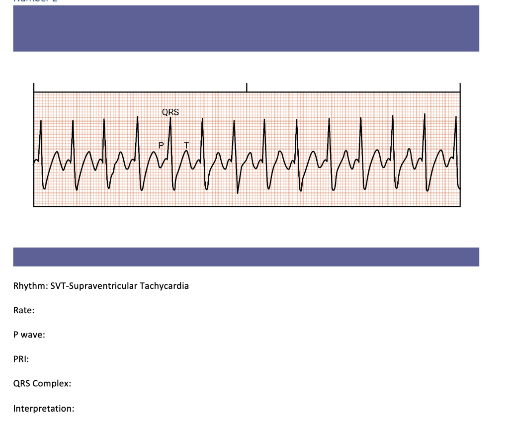 Solved Rhythm: SVT-Supraventricular Tachycardia Rate: P | Chegg.com