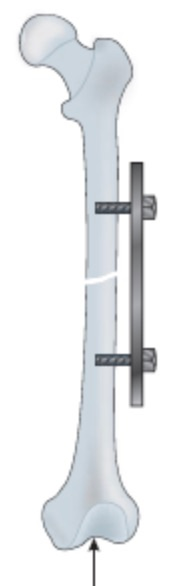 Solved Plates and rods are frequently used to help | Chegg.com