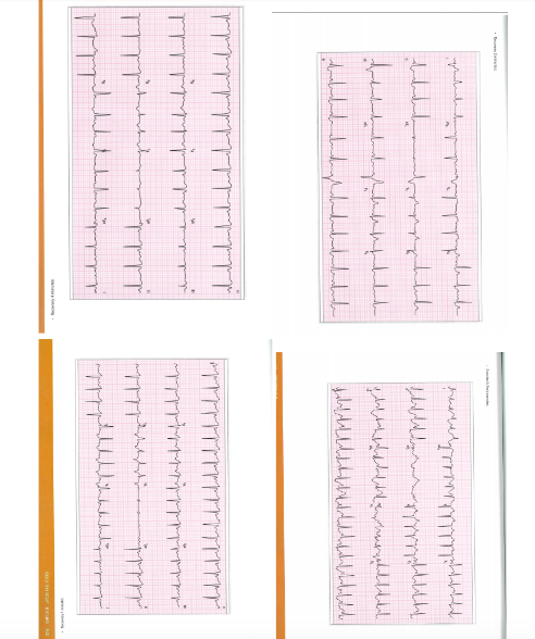 kNH 382 Assignment.CS.GXT-ECG-Echo (GXT with Imaging | Chegg.com
