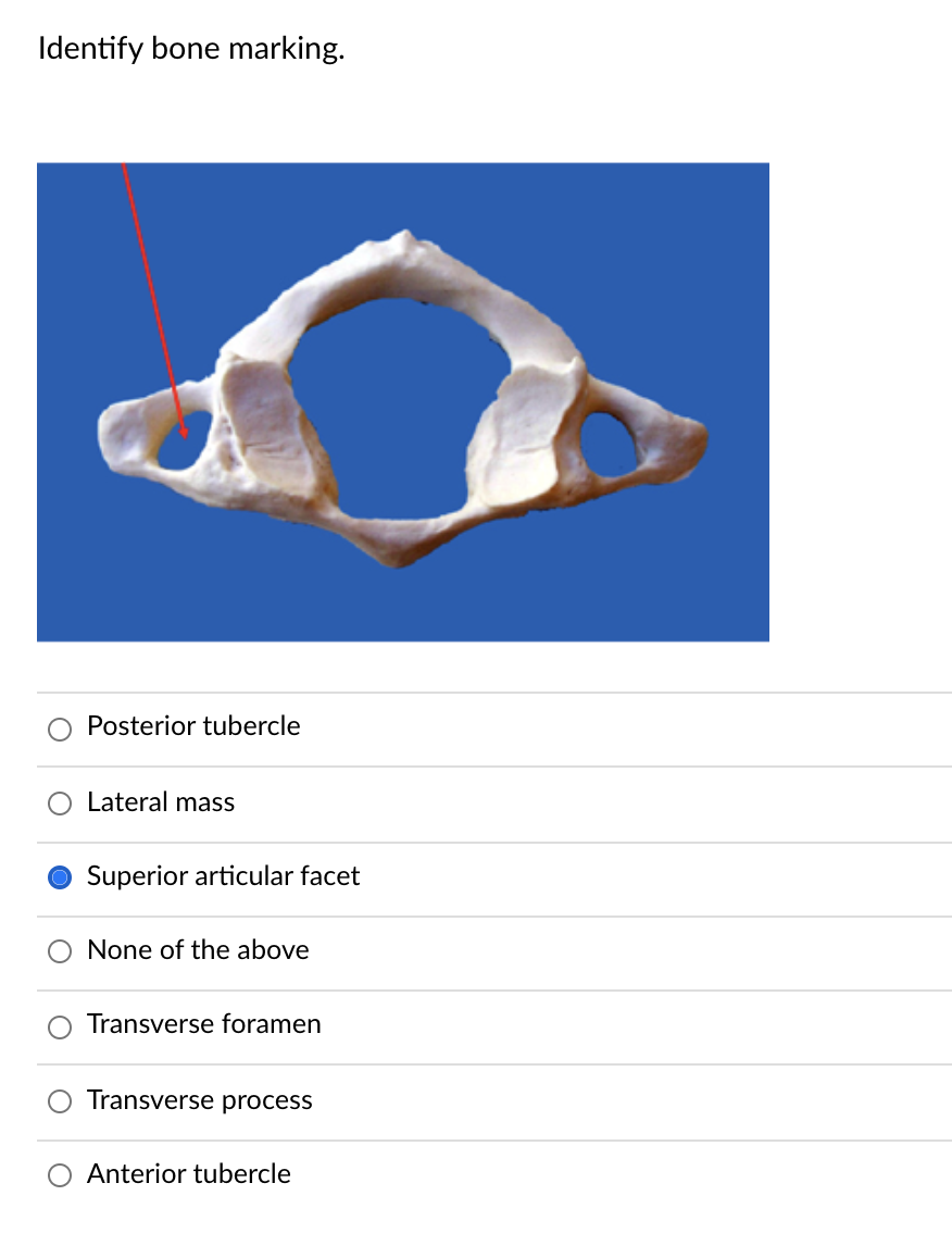 Solved Identify bone marking. O Posterior tubercle Lateral | Chegg.com