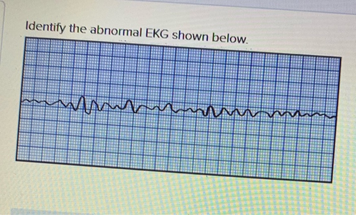 Solved Identify the abnormal EKG shown below. on the wall | Chegg.com