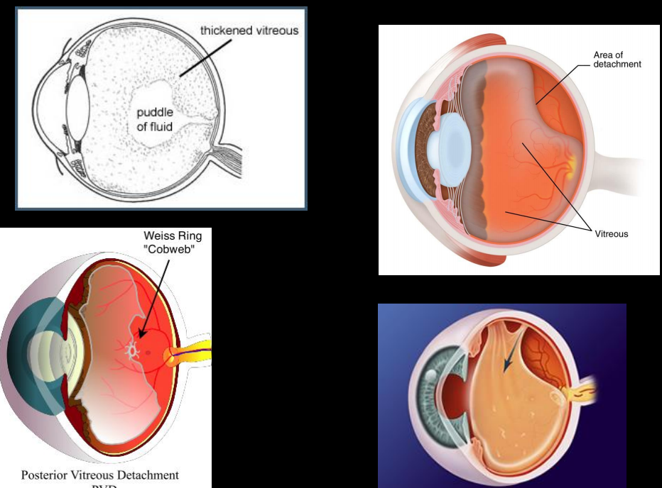 Posterior Vitreous Detachment Weiss Ring