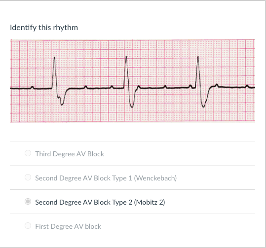 Solved Identify this rhythm Third Degree AV Block Second | Chegg.com