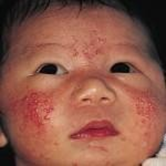 Acne Neonatorum