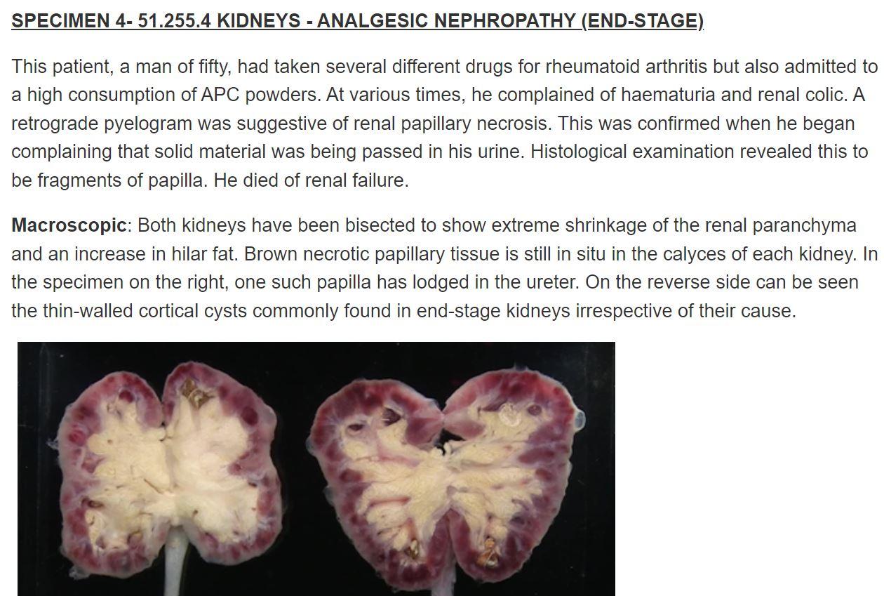 Solved SPECIMEN 4- 51.255.4 KIDNEYS - ANALGESIC NEPHROPATHY | Chegg.com