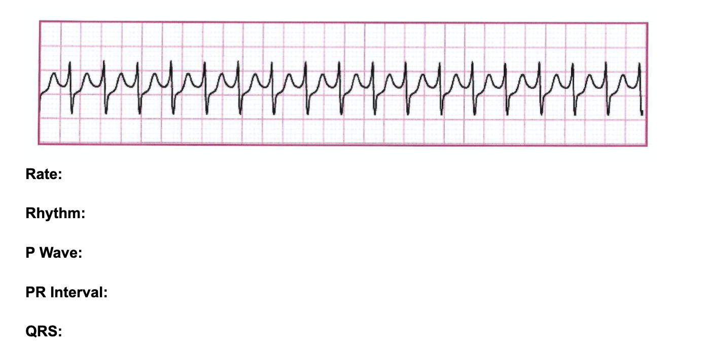 Solved Rate: Rhythm: P Wave: PR Interval: | Chegg.com
