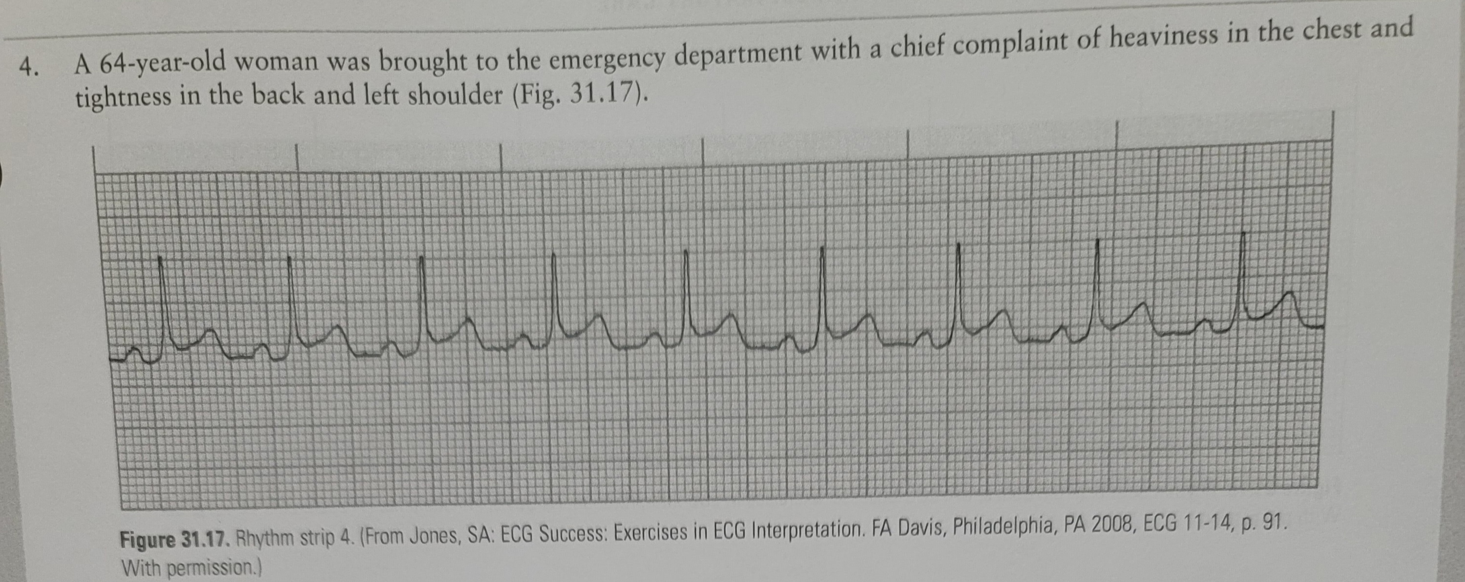 Solved A) Rate:B) Rhythm: regular or irregular?C) P waves: | Chegg.com