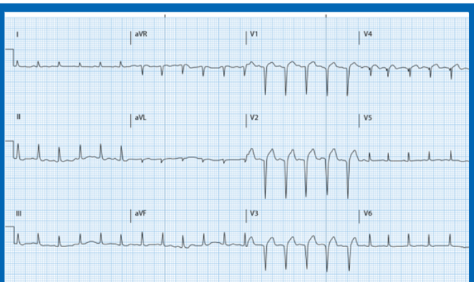 Solved what is the predominant finding of ischemia or | Chegg.com