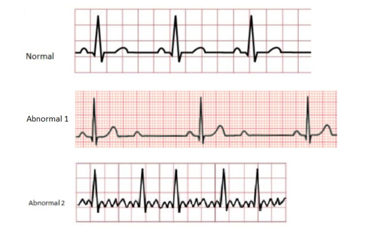 Schemes Set Of Common Electrocardiogram (ECG), 49% OFF Schemes Set Of Common Electrocardiogram (ECG), 49% OFF