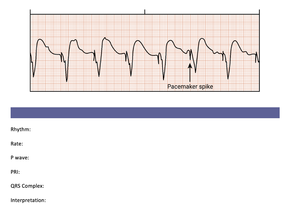 Solved Rhythm: Rate: P wave: PRI: QRS Complex: | Chegg.com
