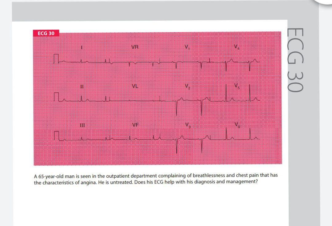 Solved ECG 30 1 VR V V. ECG 30 II VL m 111 VE V V A | Chegg.com