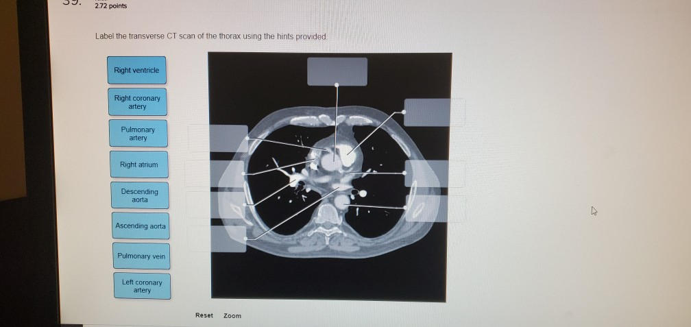 Solved 39. 272 points Label the transverse CT scan of the | Chegg.com