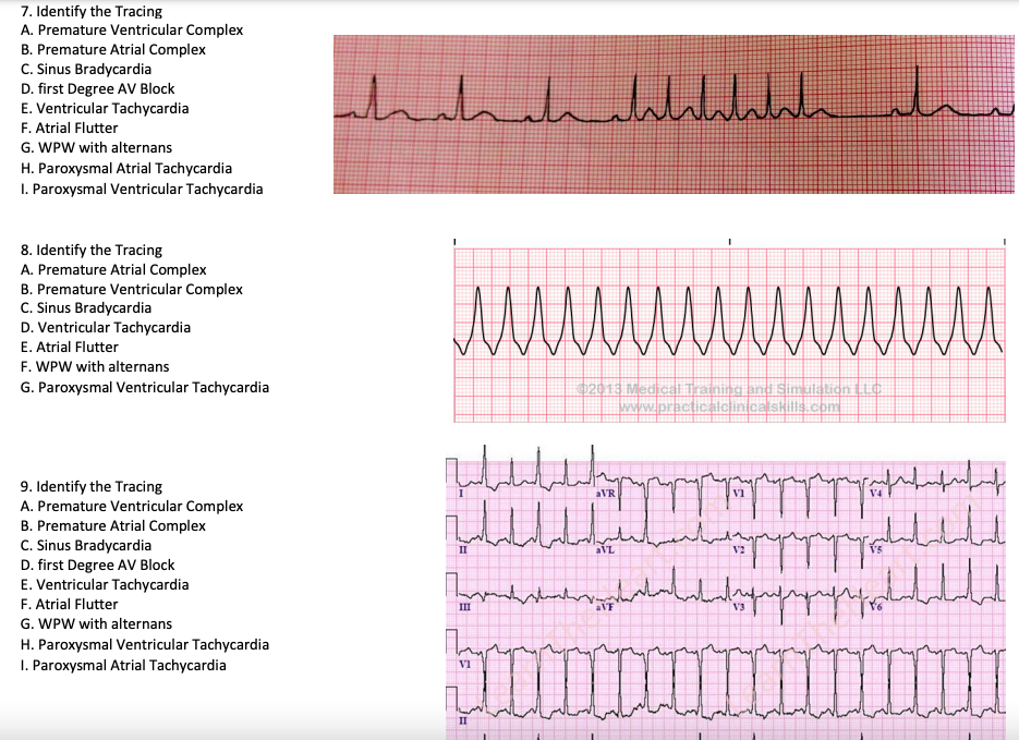 Premature Atrial Complex