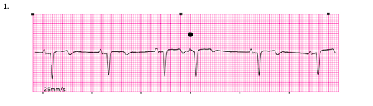 Solved Label the atrial arrhythmia type on the EKG strip: | Chegg.com