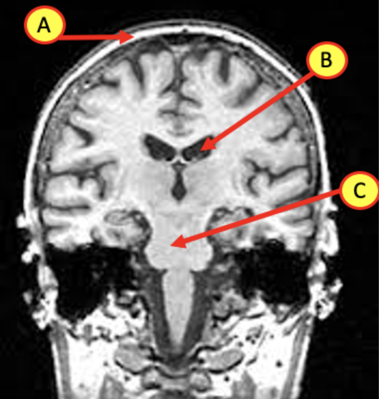 Solved In the CT scan, identify the tissue type indicated at | Chegg.com